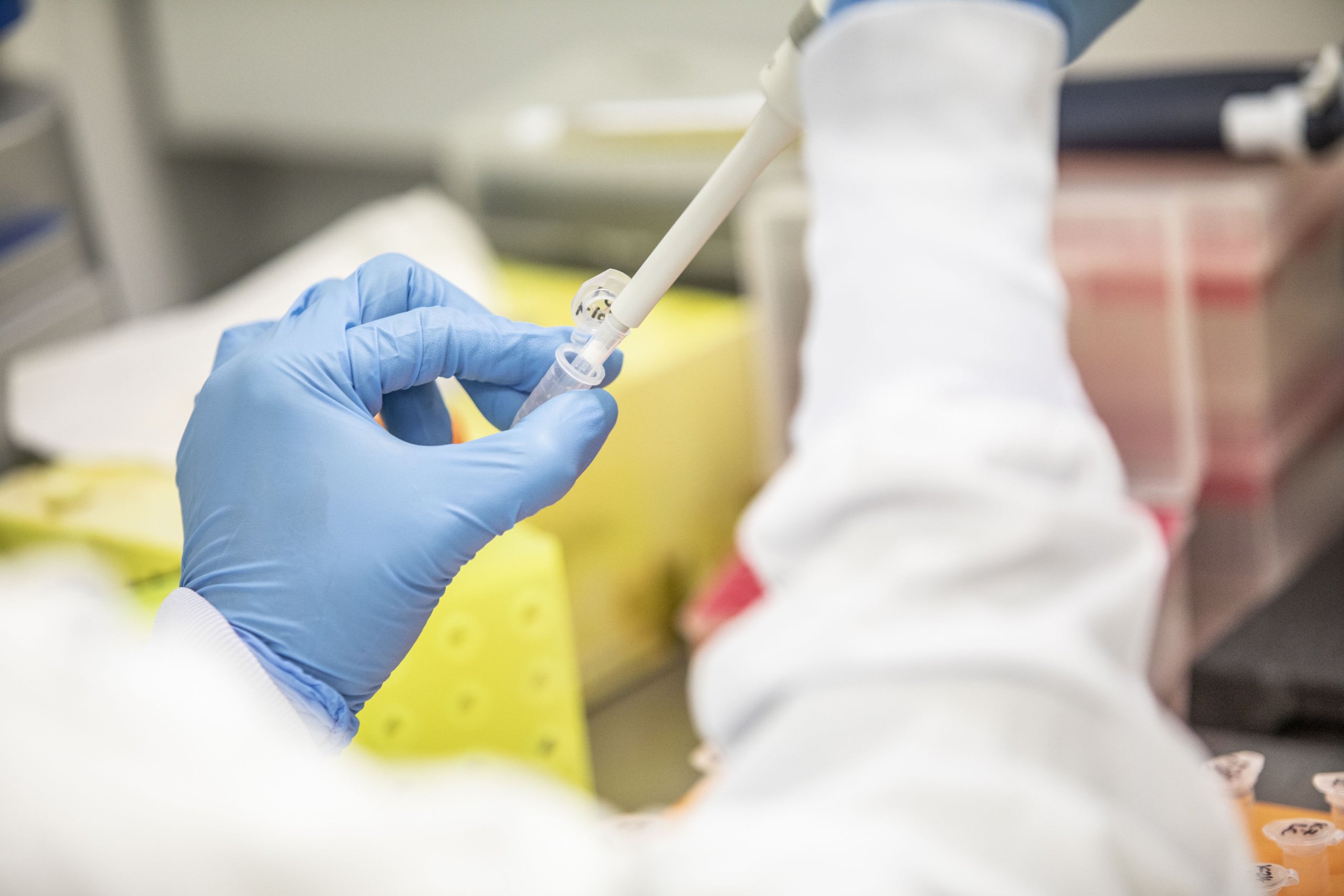 New clues in understanding faster disease progression in multiple ...
