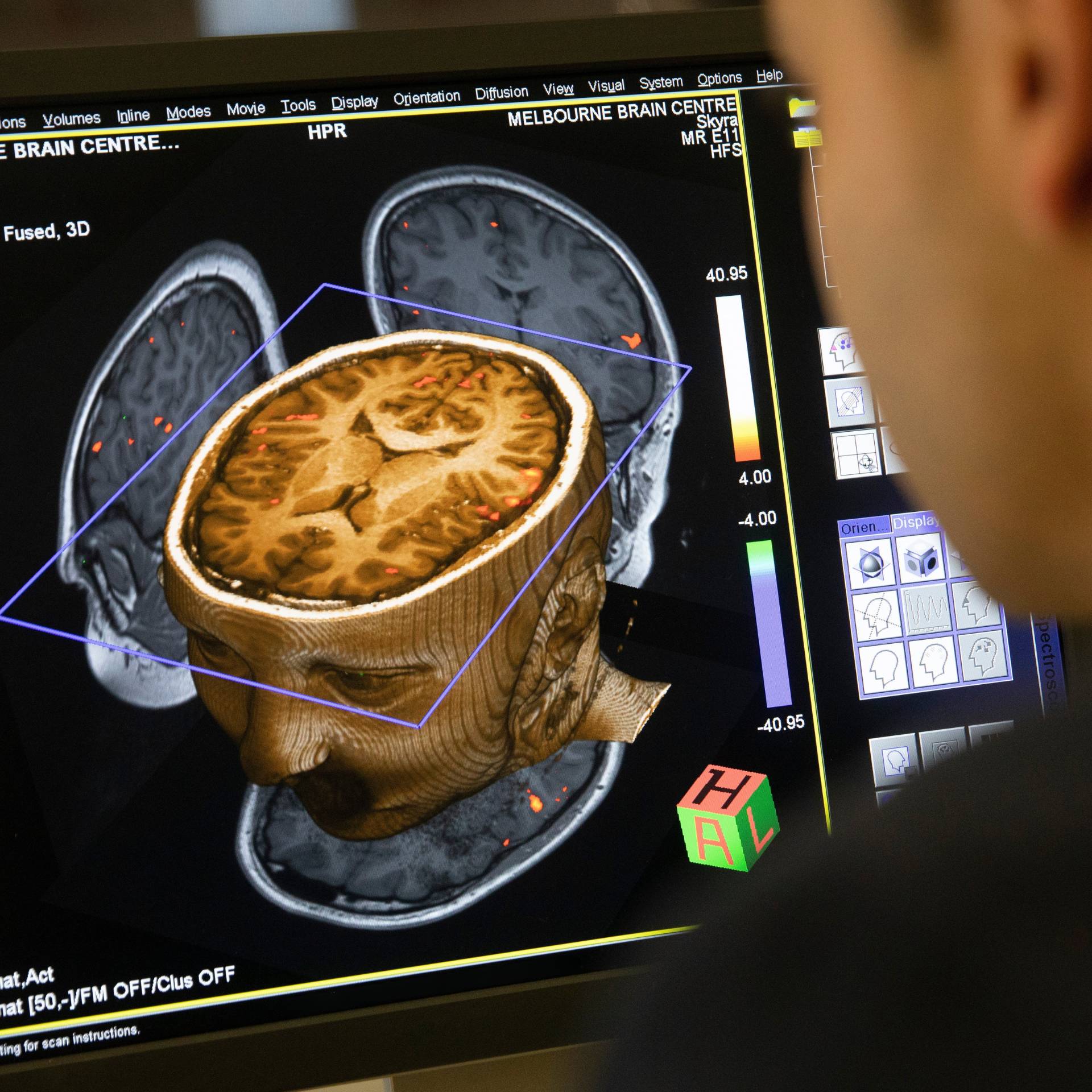 Epilepsy and Neurodevelopment Research Priority | Research priorities ...